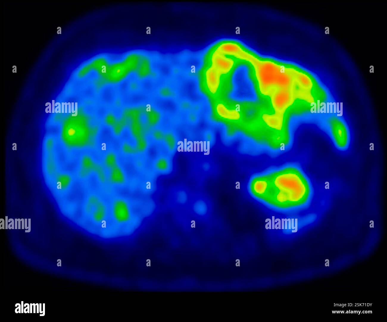 Kaposi's sarcoma on face of AIDS patient Stock Photo - Alamy