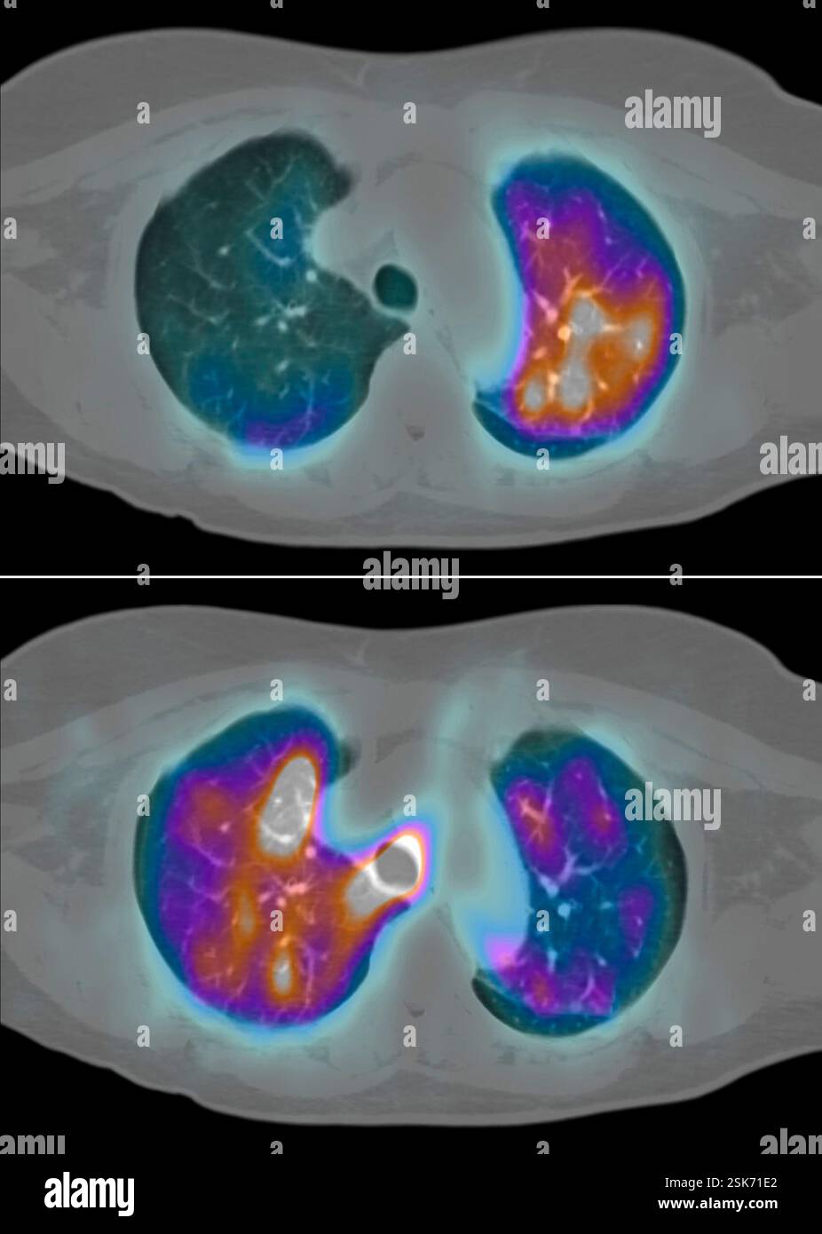 Coloured ventilation-perfusion scintigrams combined with computed ...