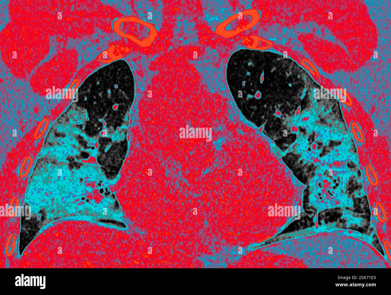 Coloured computed tomography (CT) scan (frontal view) of the lungs of a ...