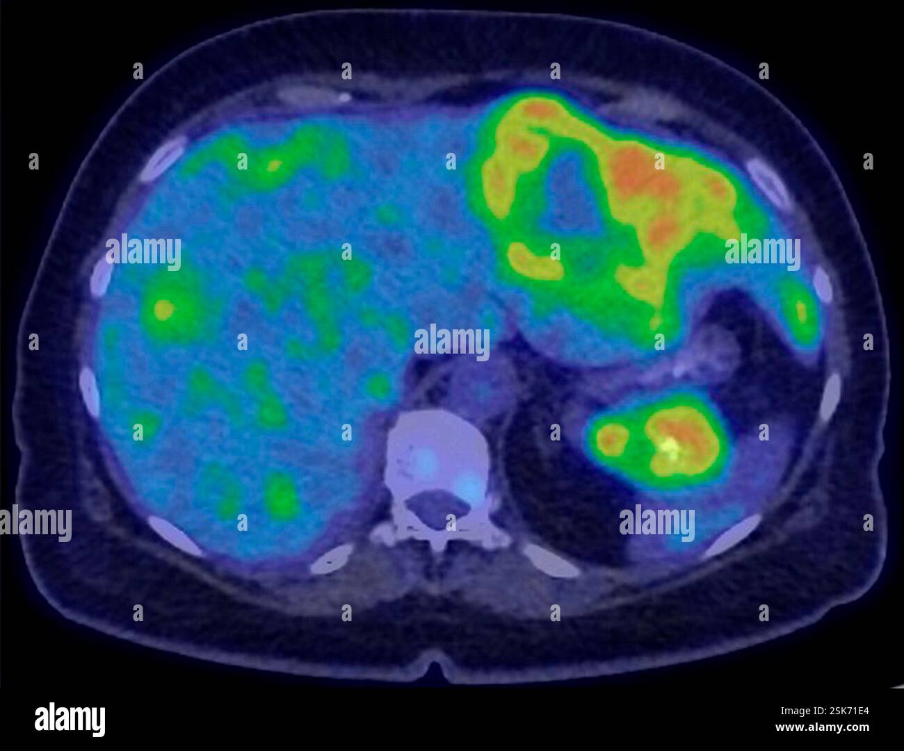Kaposi's sarcoma on foot of AIDS patient Stock Photo - Alamy