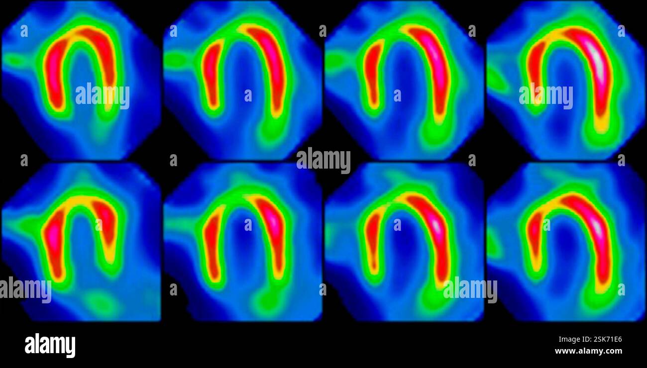Coloured axial SPECT (single photon emission computed tomography) scans ...
