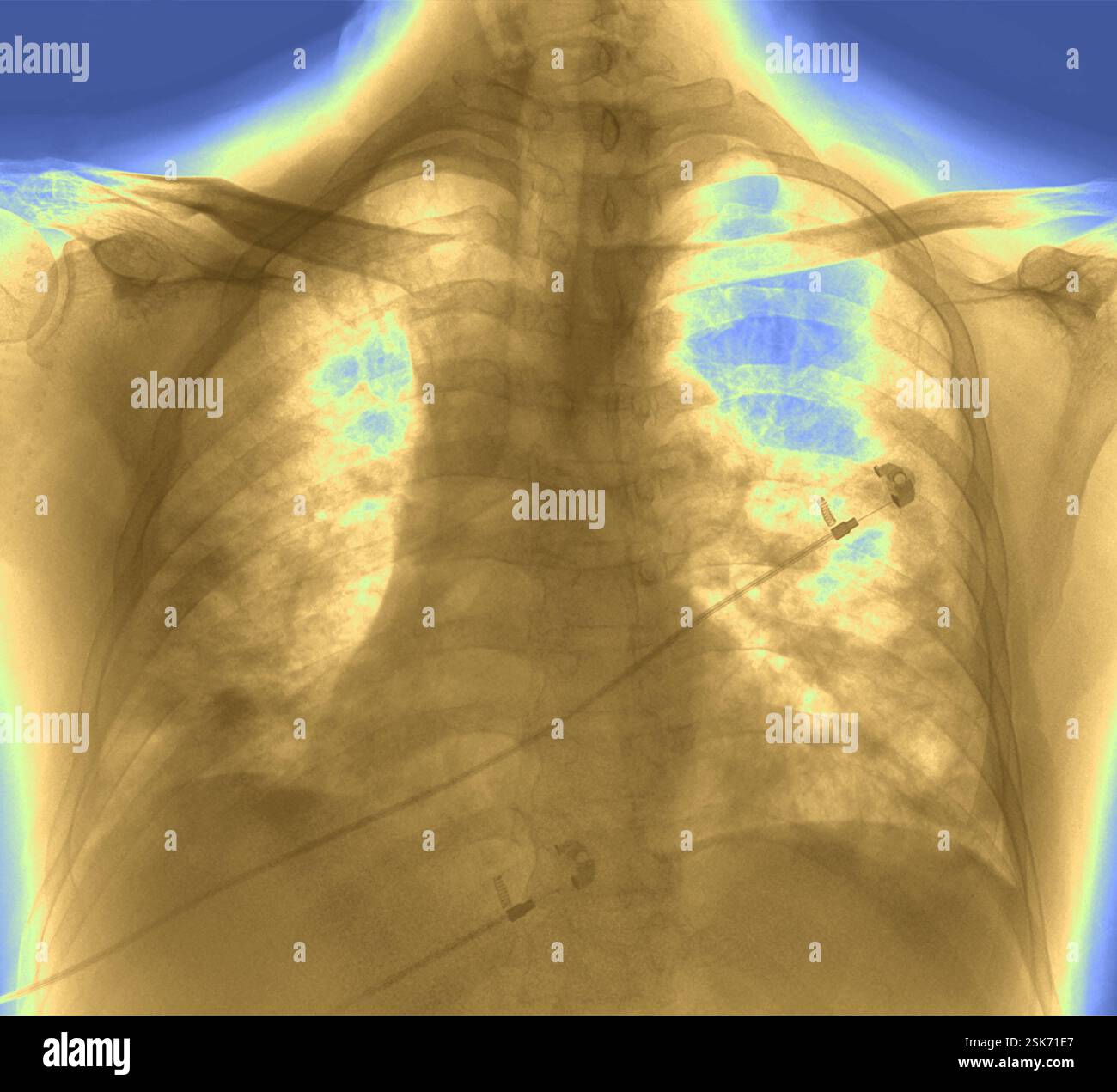 Coloured X-ray (frontal view) of the lungs of a 47 year old male ...