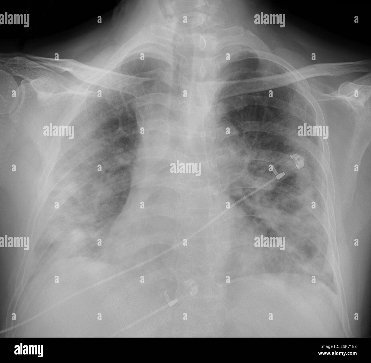 X-ray (frontal view) of the lungs of a 47 year old male patient with ...