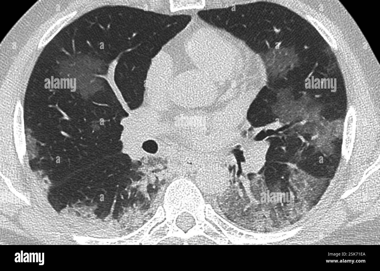 Computed tomography (CT) scan (axial view) of the lungs of a 50 year ...