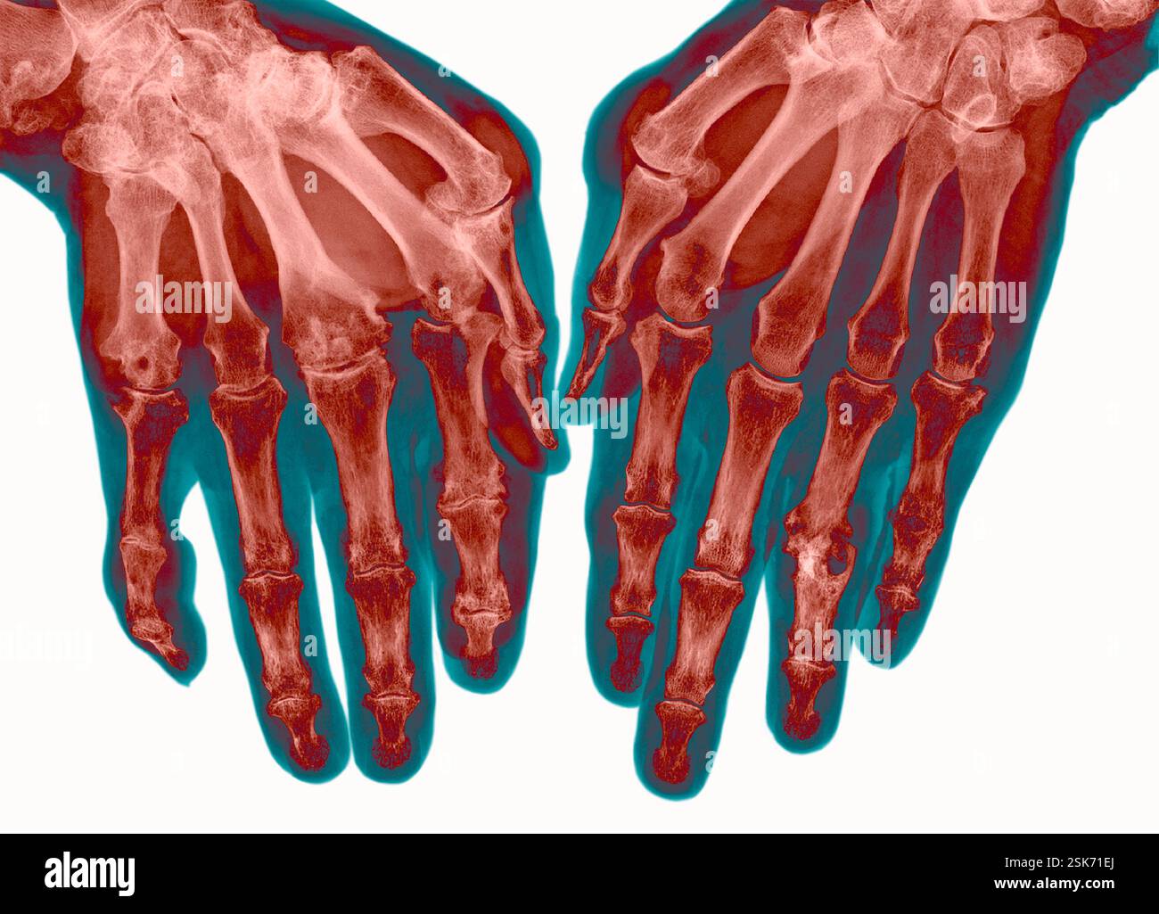 Coloured X-ray of the hands of a patient with gout in the joints of the ...