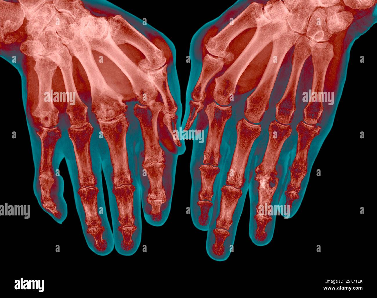 Coloured X-ray of the hands of a patient with gout in the joints of the ...