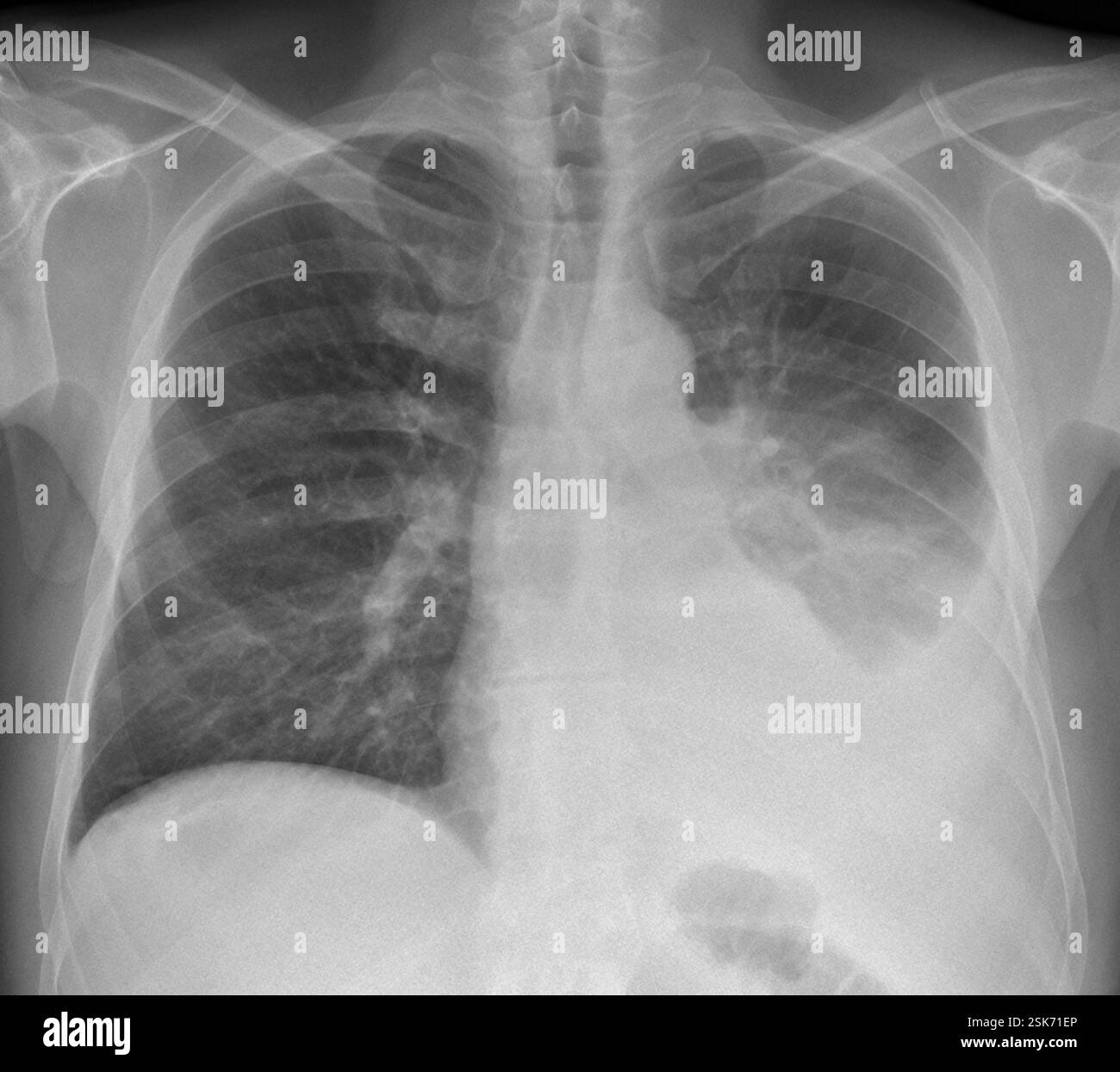 X-ray of the lungs of a 62 year old male patient with pleurisy ...