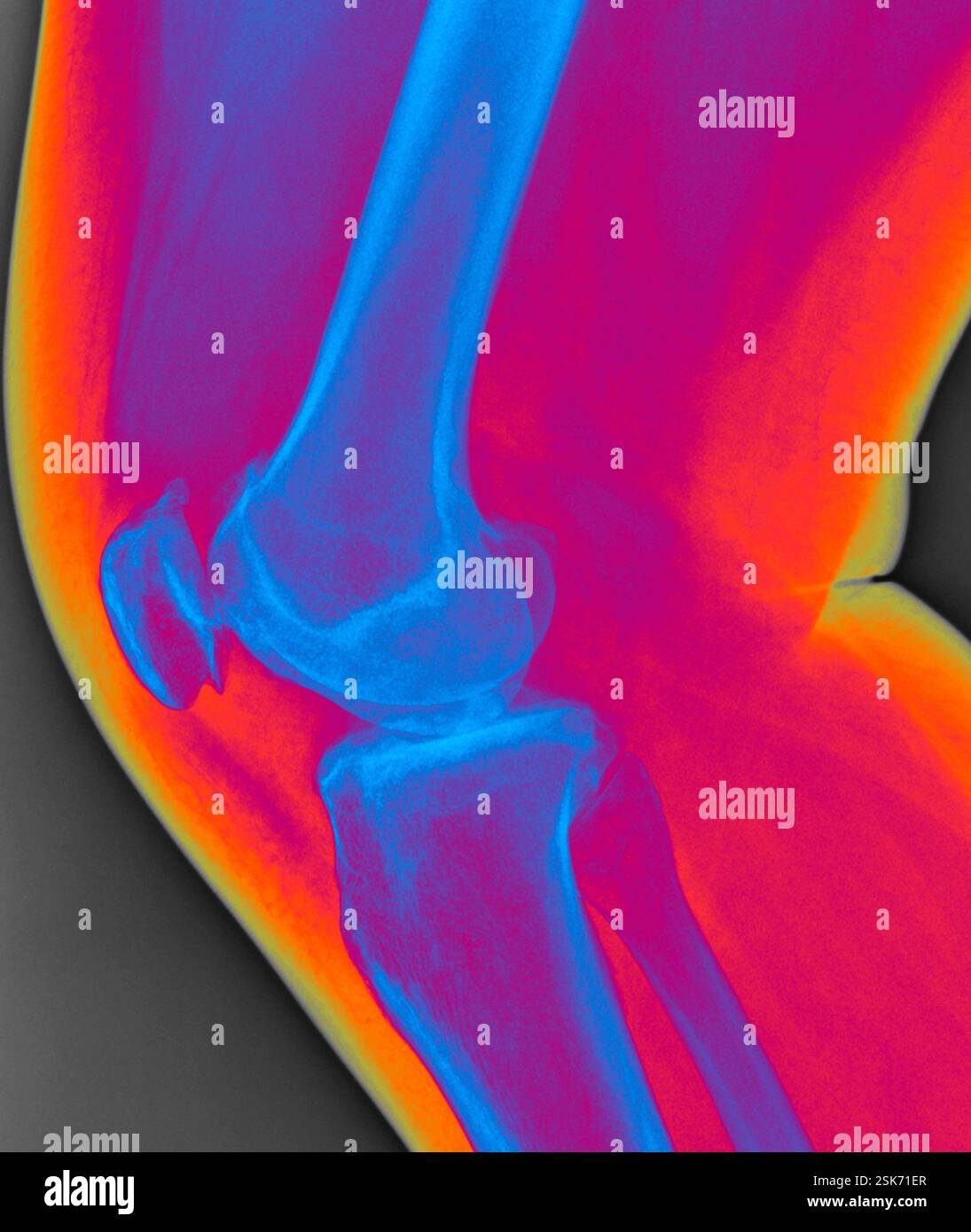 Coloured X-ray of a side view of the right knee of a 73 year old female ...