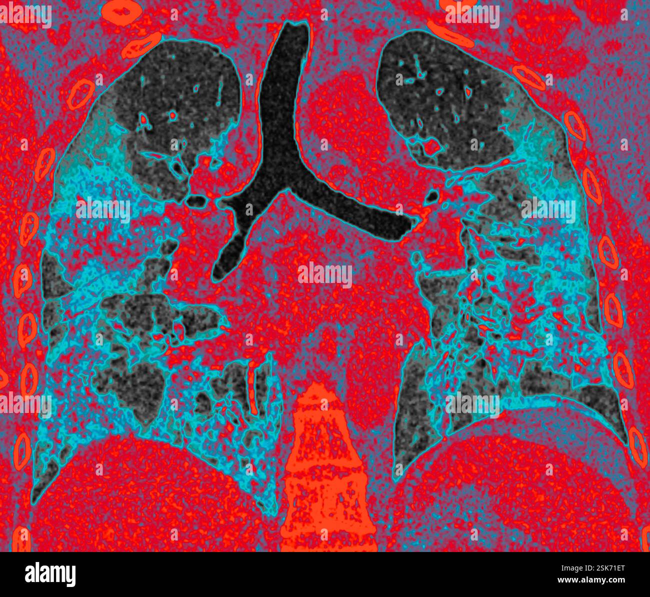 Coloured computed tomography (CT) scan (frontal view) of the lungs of a ...