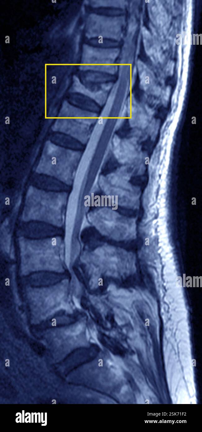 Coloured magnetic resonance imaging (MRI) scan of the spine of a 75 ...