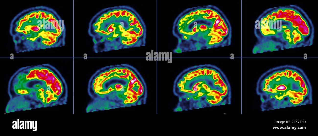 Series of coloured sagittal positron emission tomography (PET) scans ...