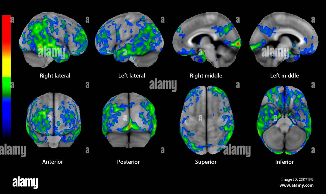 Series of coloured 3D positron emission tomography (PET) scans of the ...