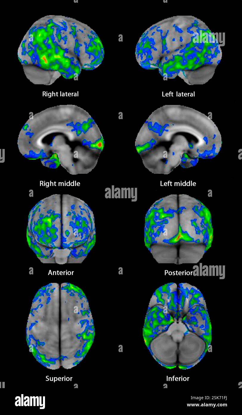 Series of coloured 3D positron emission tomography (PET) scans of the ...