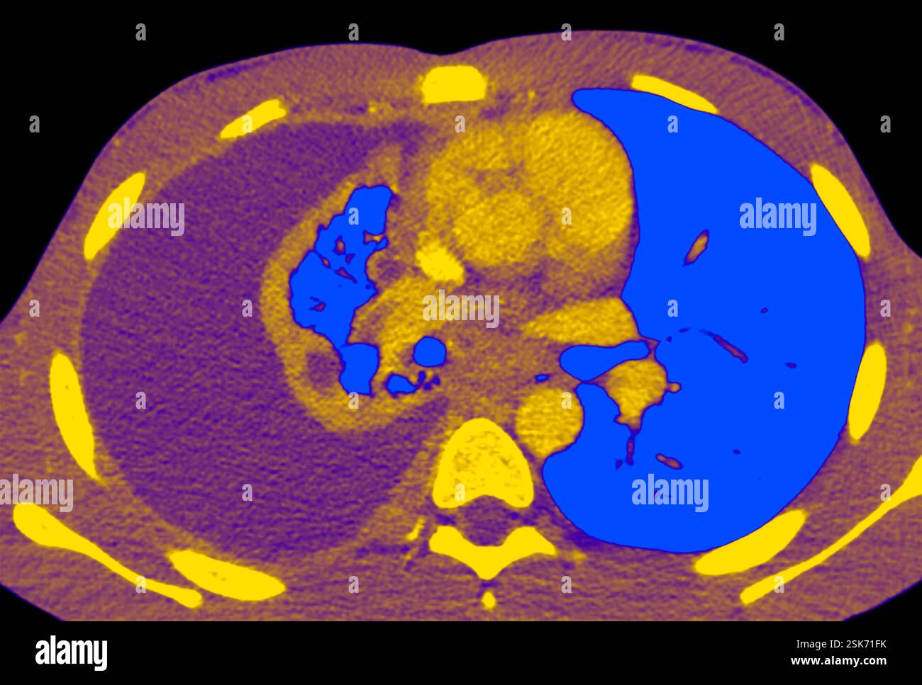 Coloured computed tomography (CT) scan of the lungs of a 24 year old ...