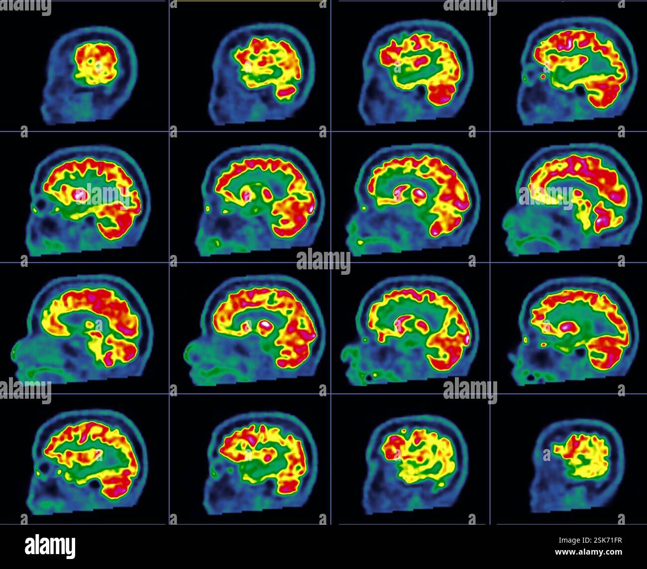 Series of coloured sagittal positron emission tomography (PET) scans ...