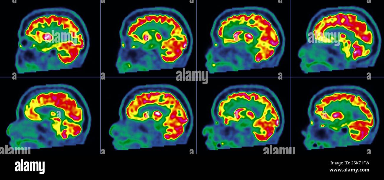 Series of coloured sagittal positron emission tomography (PET) scans ...