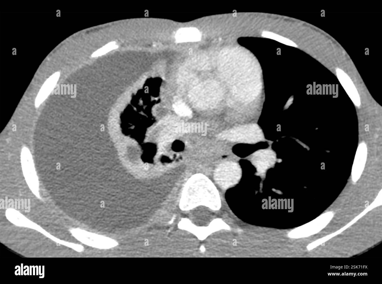 Computed tomography (CT) scan of the lungs of a 24 year old male ...