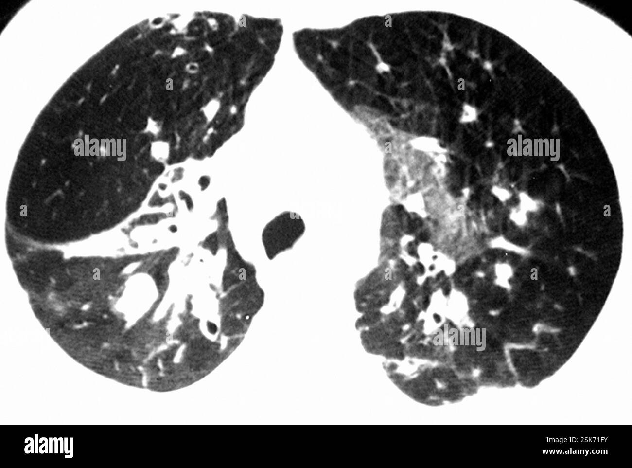 Computed tomography (CT) scan of the lungs of a 19 year old female ...