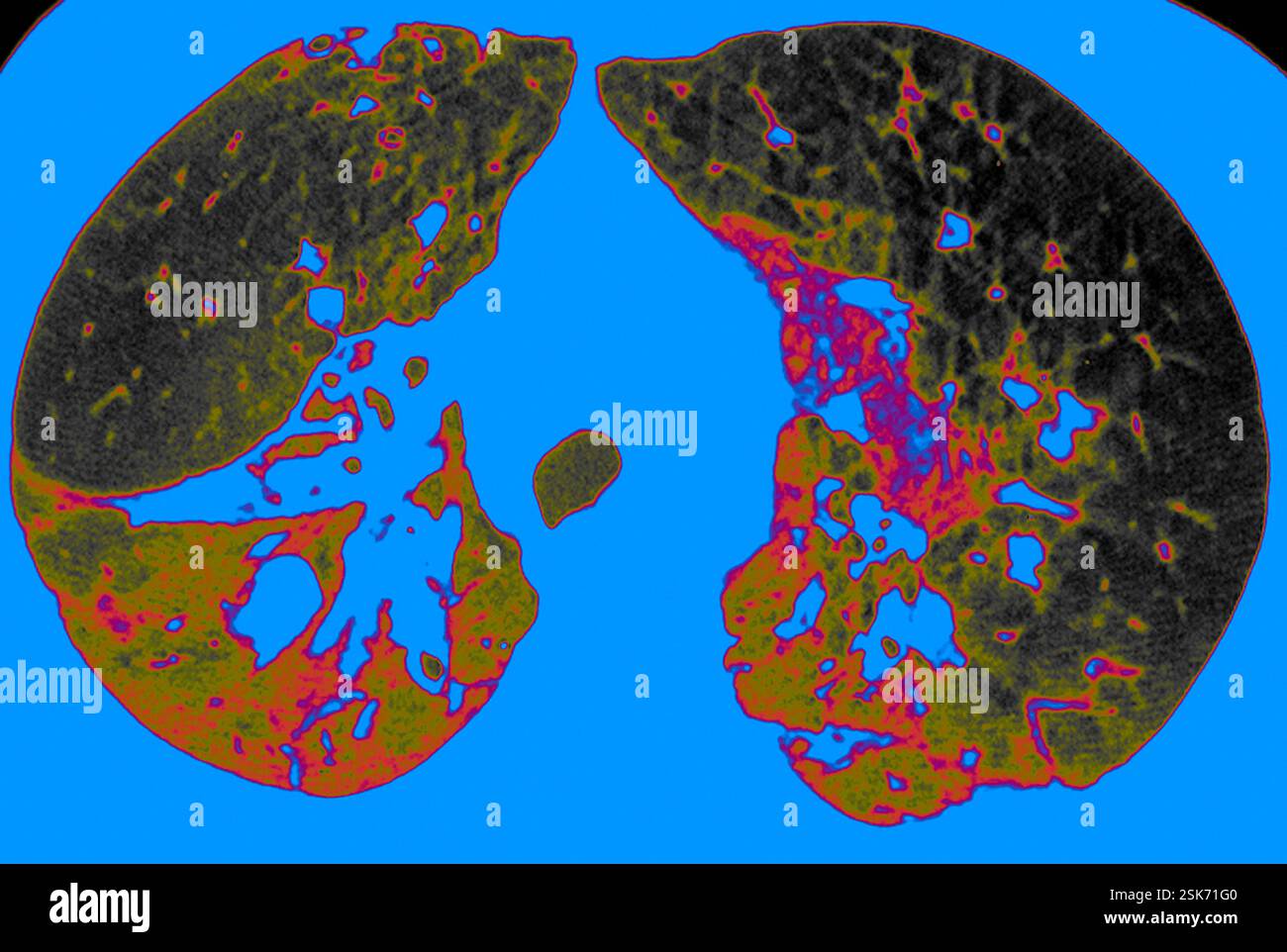Coloured computed tomography (CT) scan of the lungs of a 19 year old ...