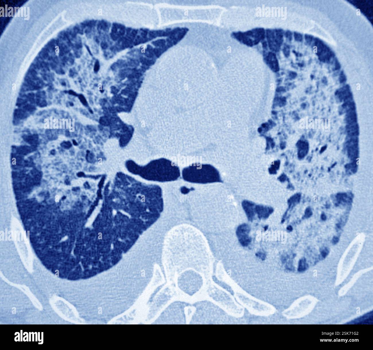 Toxic multinodular goitre, scintigram Stock Photo - Alamy