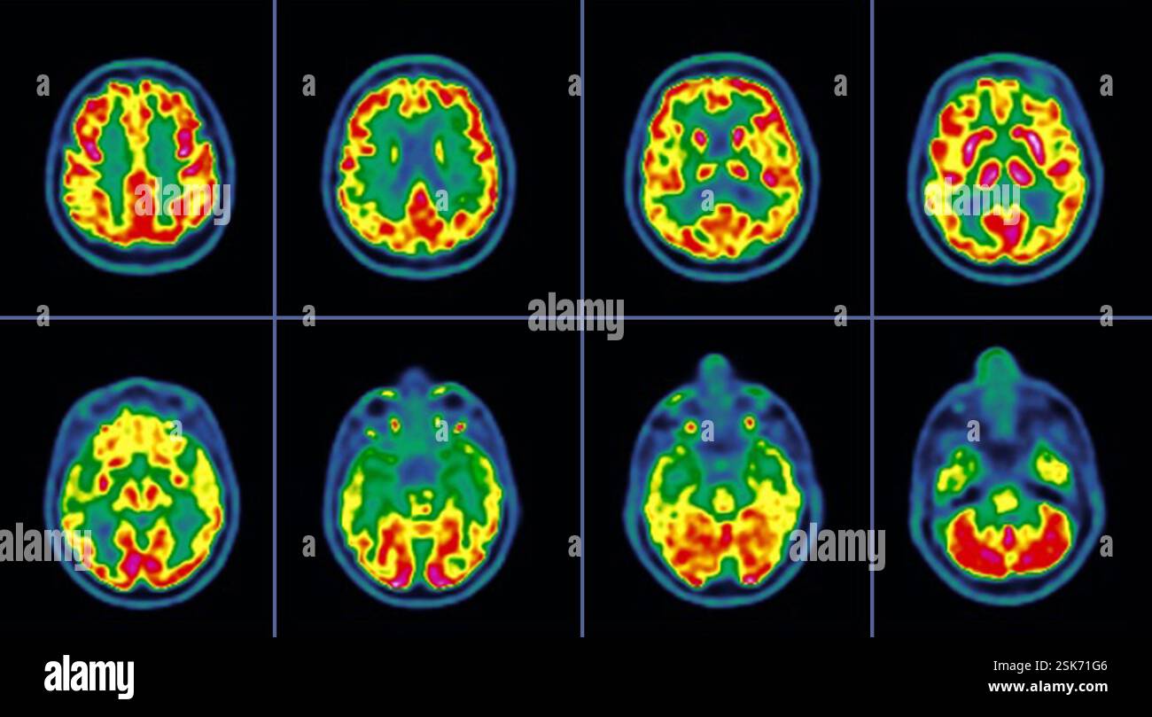 Series of coloured axial positron emission tomography (PET) scans ...