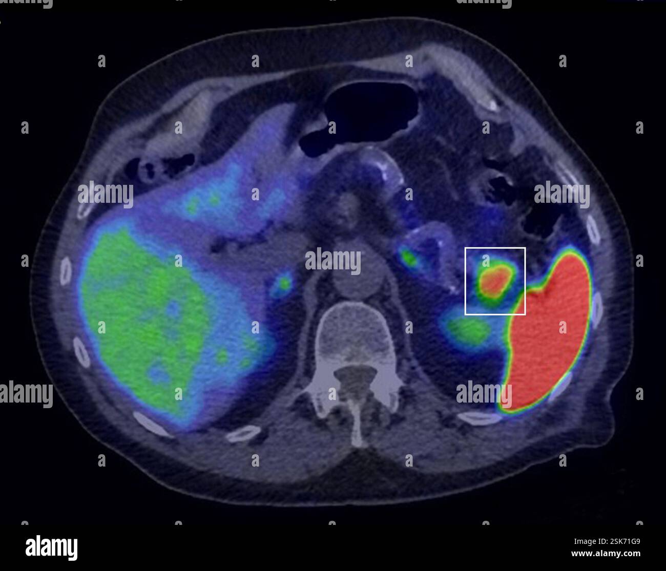 Secondary spinal cancer, composite scintigram and CT scan Stock Photo ...