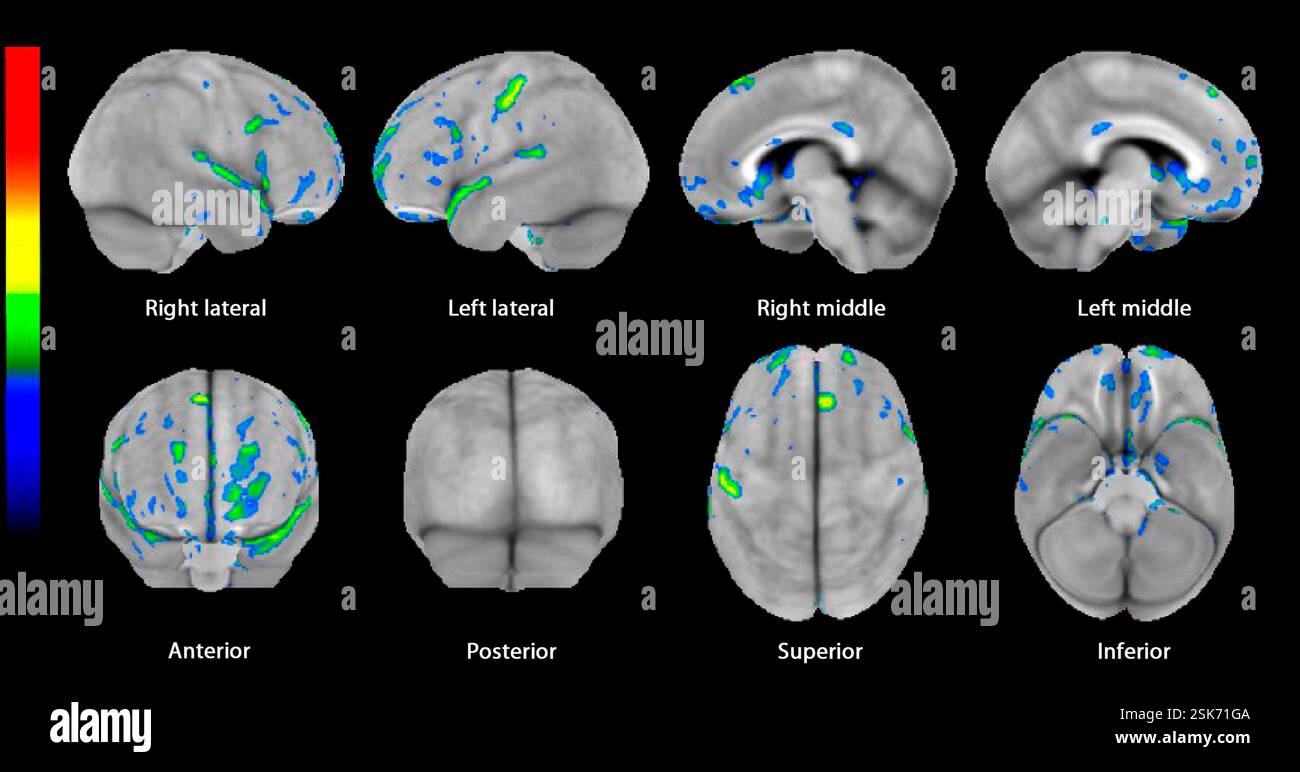 Series of coloured 3D positron emission tomography (PET) scans of the ...