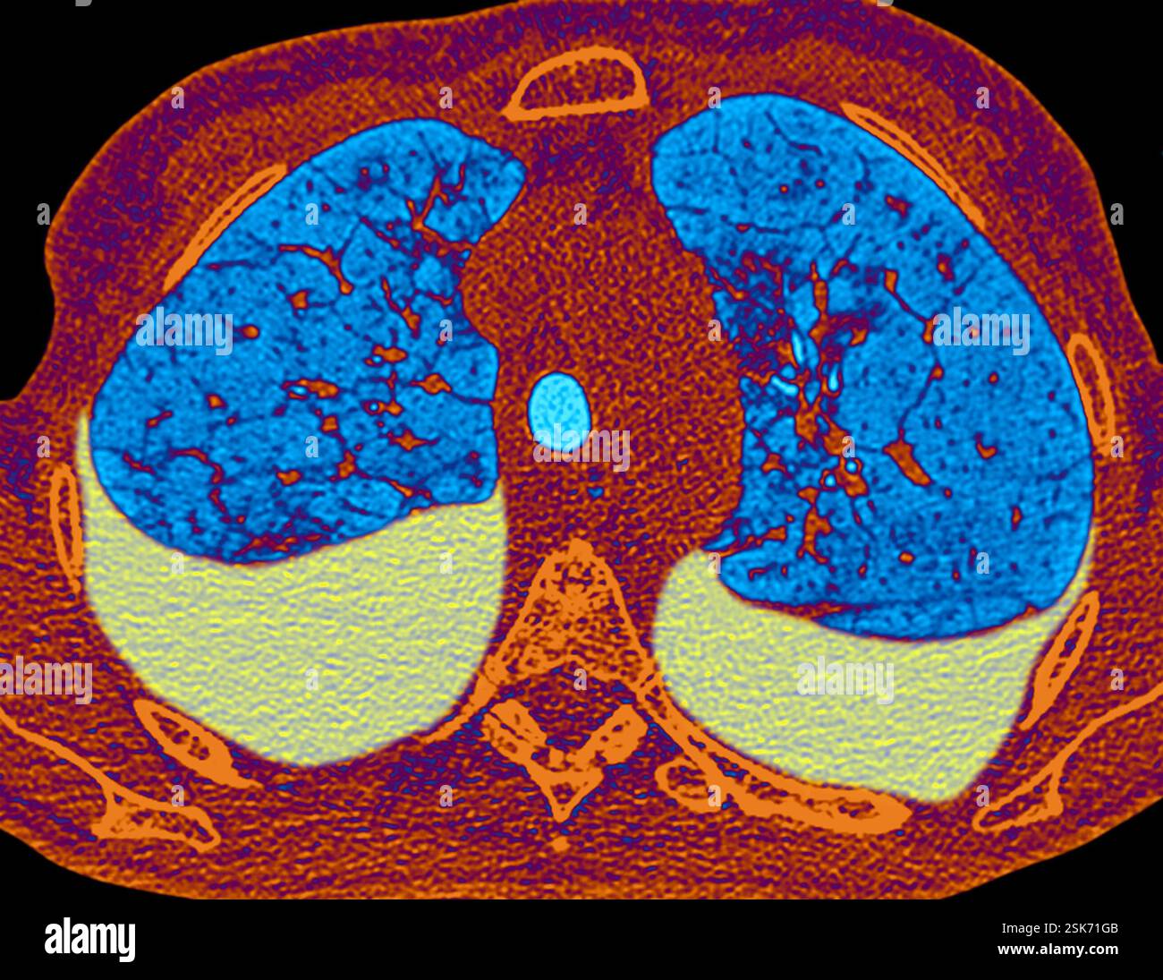 Secondary cancer before and after treatment, PET scan Stock Photo - Alamy