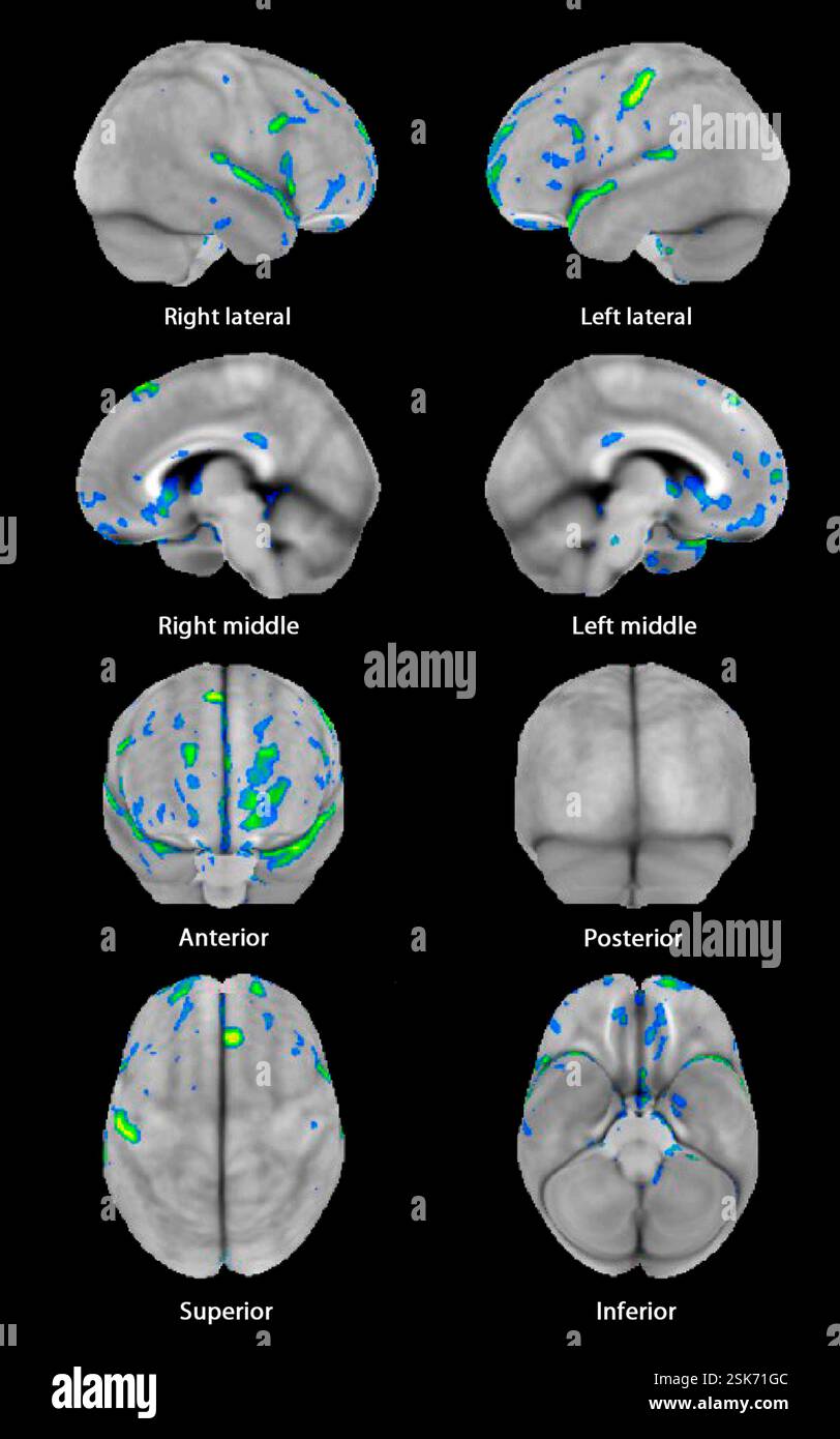 Series of coloured 3D positron emission tomography (PET) scans of the ...