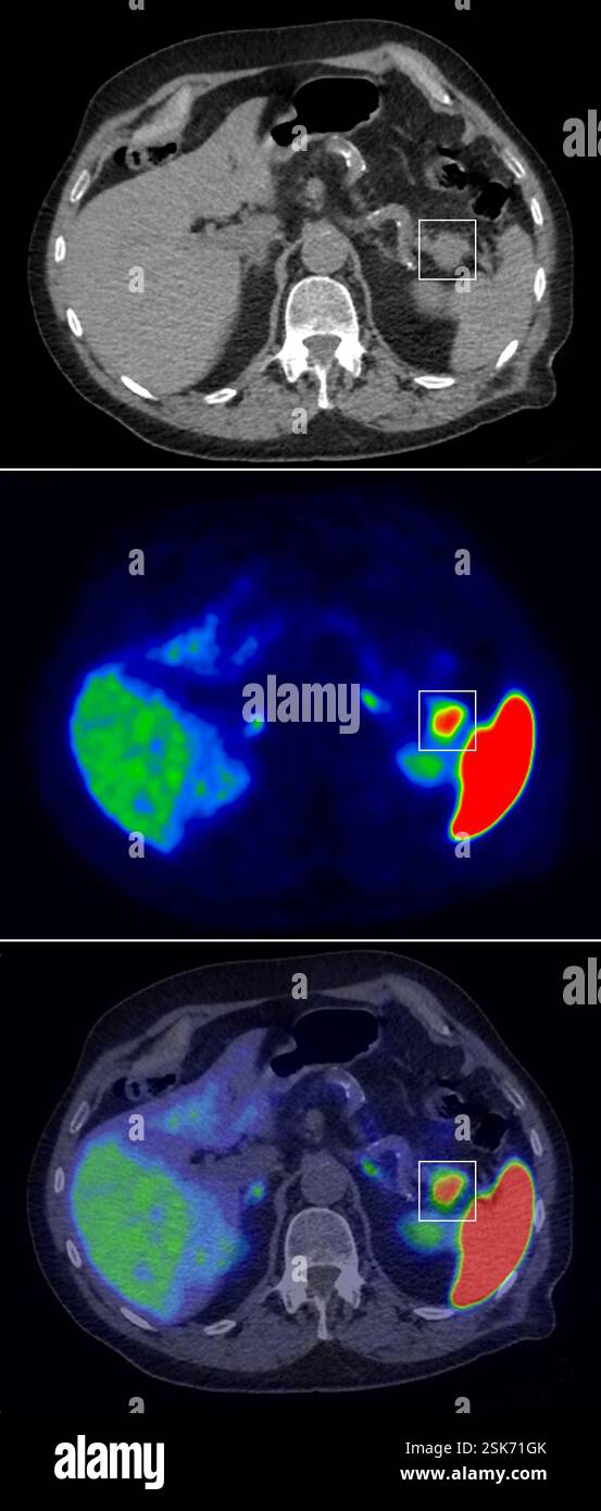 Secondary spinal cancer, composite scintigram and CT scan Stock Photo ...