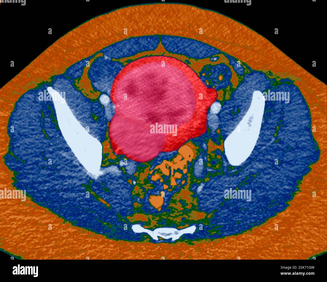 Coloured computed tomography (CT) scan in axial section of the pelvis of a 52-year-old female ...