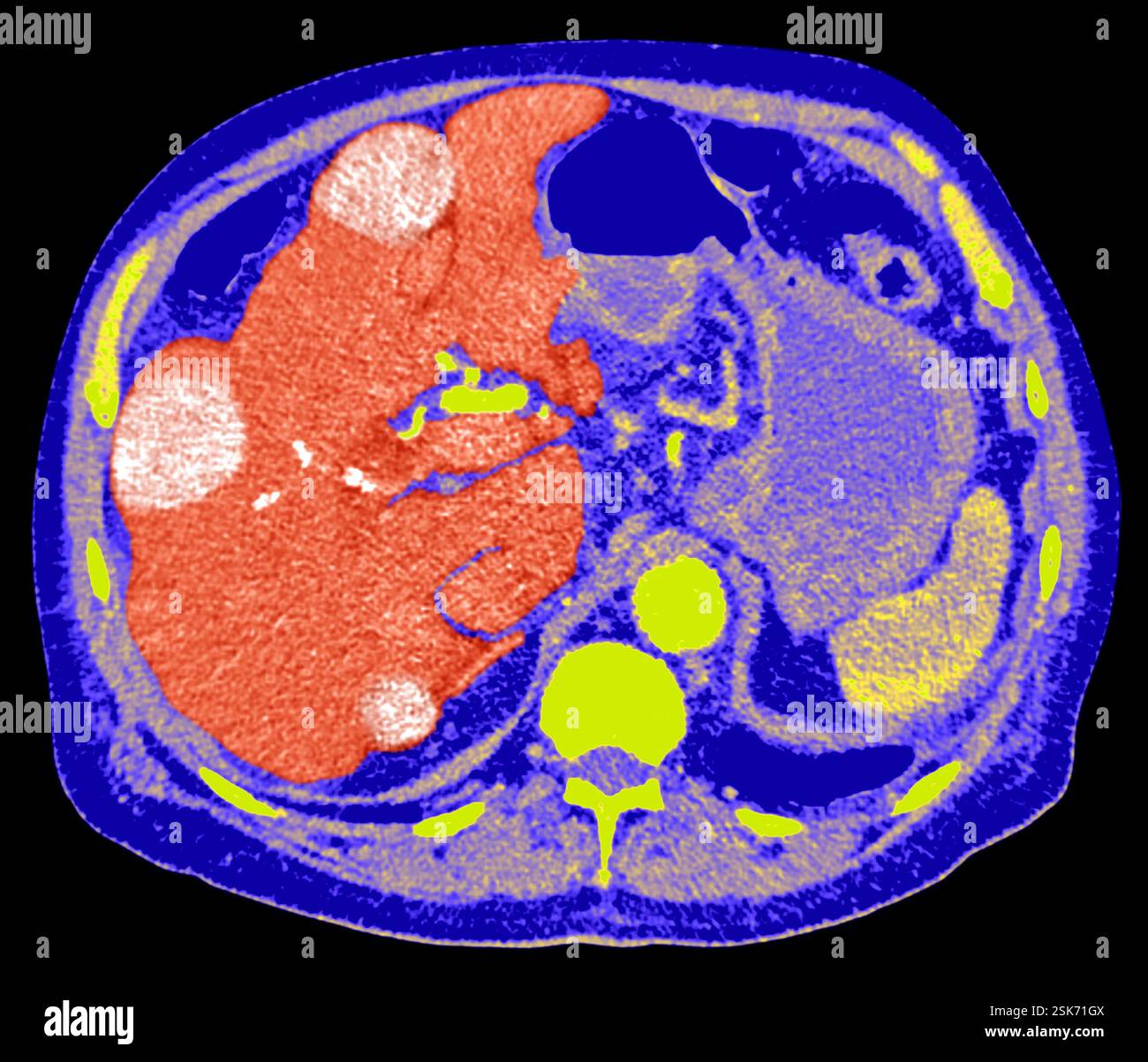 Liver cancer. Computed tomography (CT) scan of an axial section through the abdomen of a patient ...