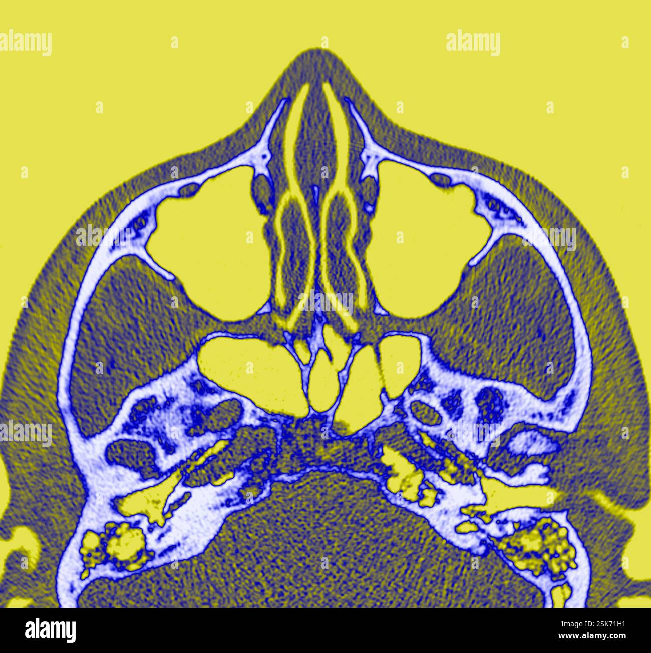 Coloured computed tomography (CT) scan section through the head showing ...