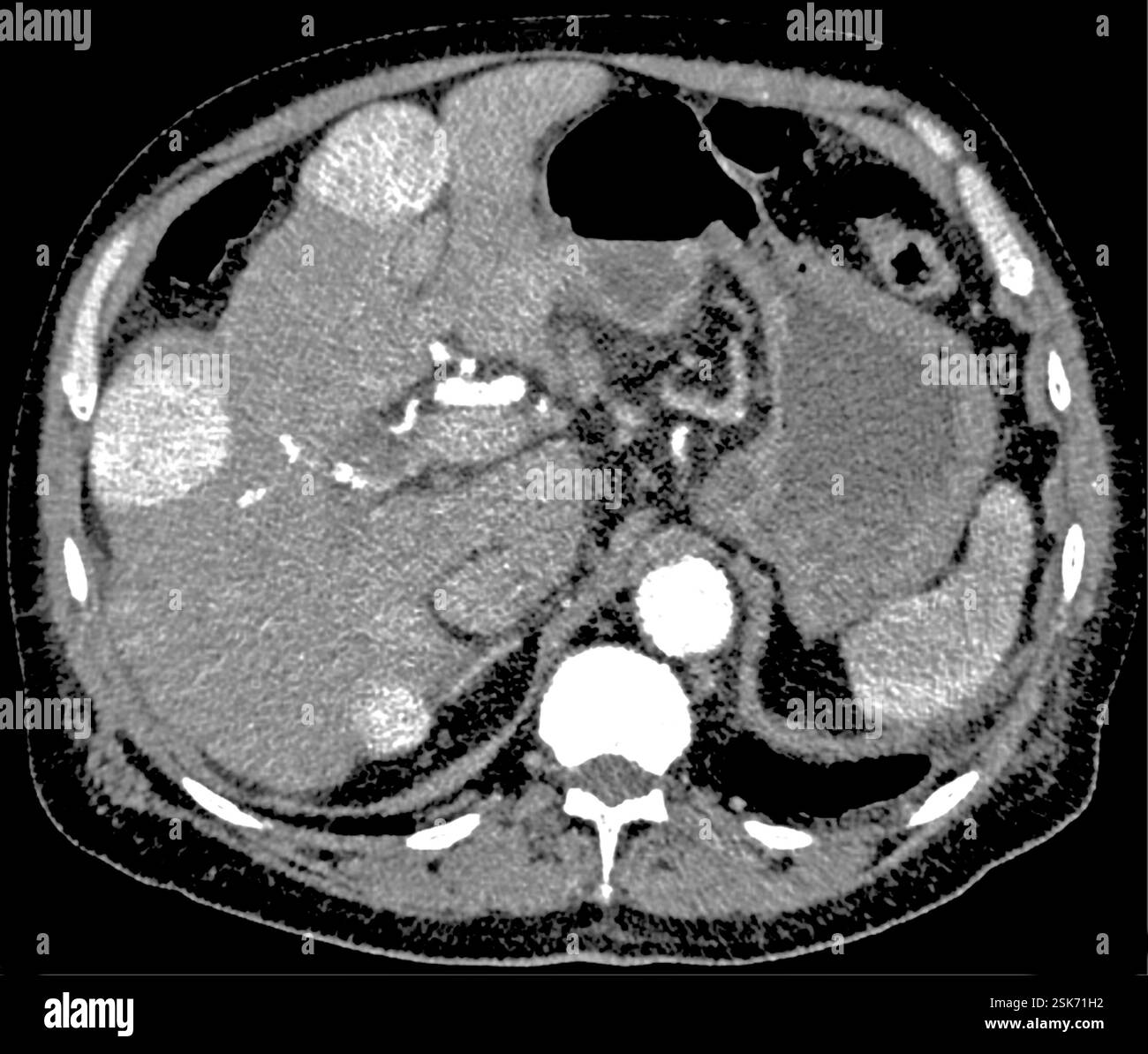 Liver cancer. Computed tomography (CT) scan of an axial section through ...