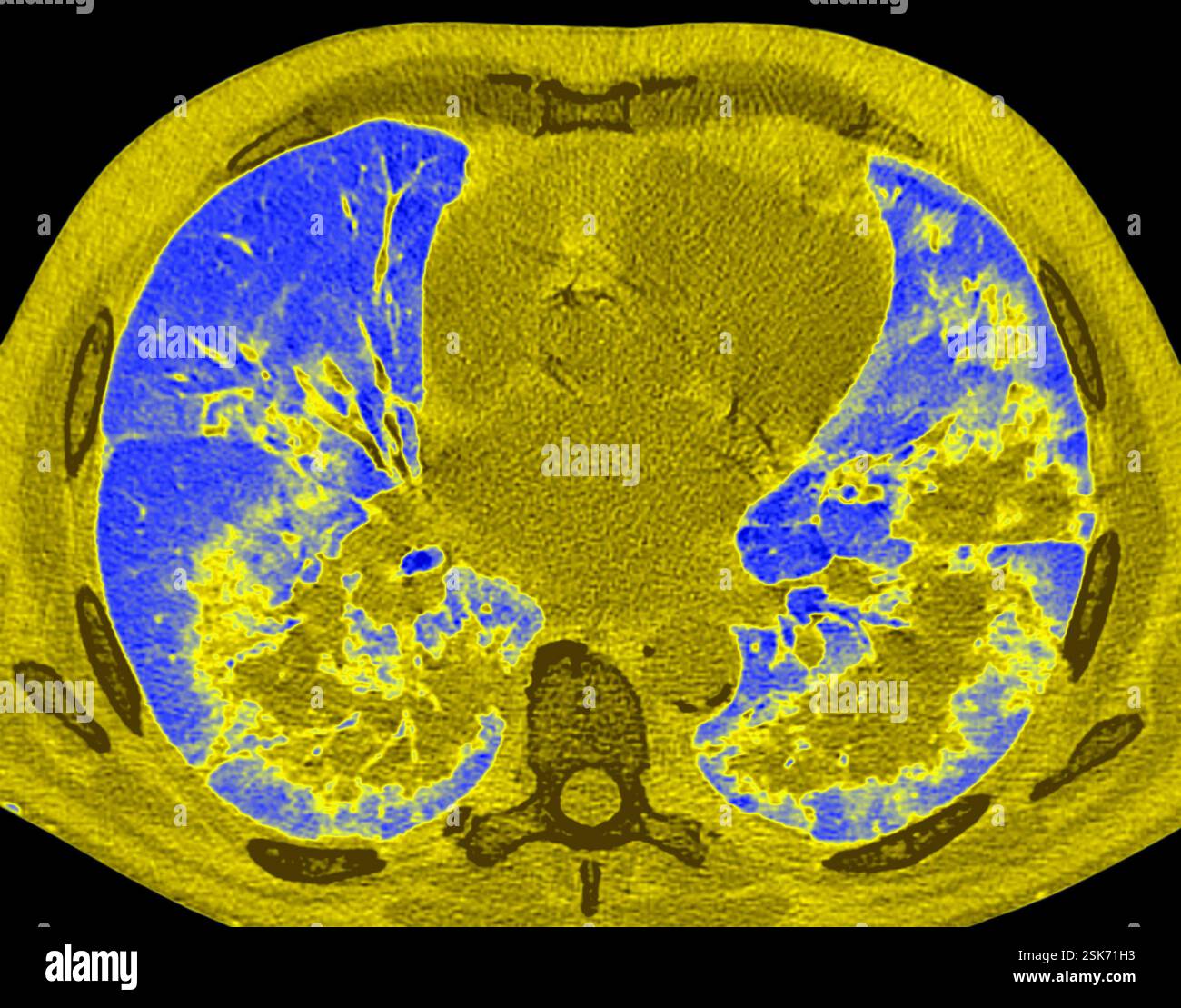 Secondary bone cancer of the spine, scintigram and CT scans Stock Photo ...