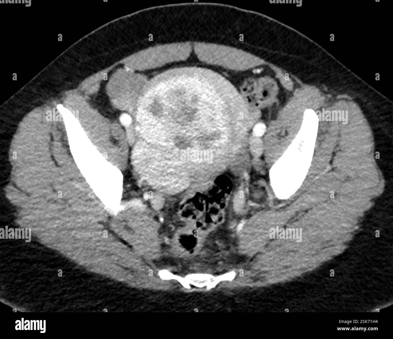 Computed tomography (CT) scan in axial section of a 52-year-old female ...