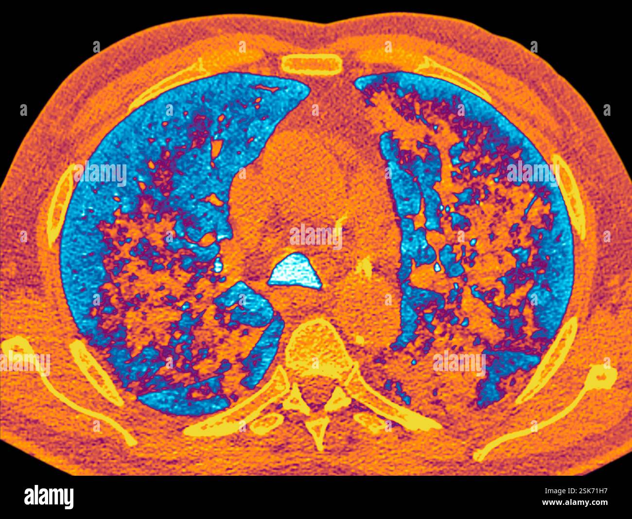 Secondary bone cancer of the spine, scintigram and CT scans Stock Photo ...
