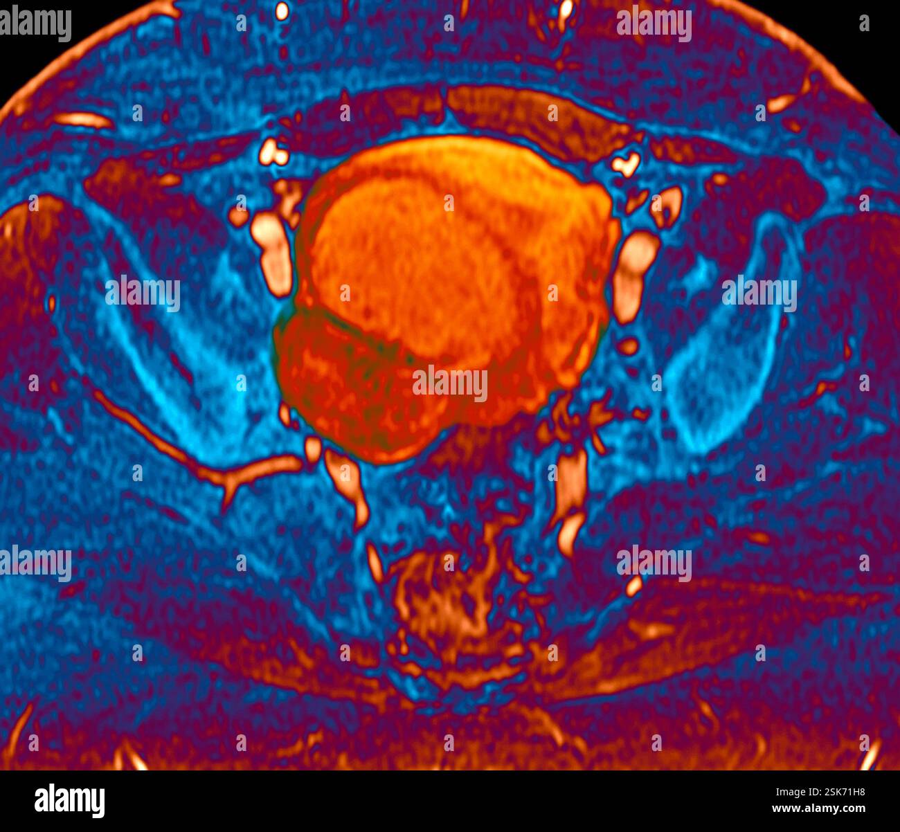 Coloured magnetic resonance imaging (MRI) section through the pelvis of ...