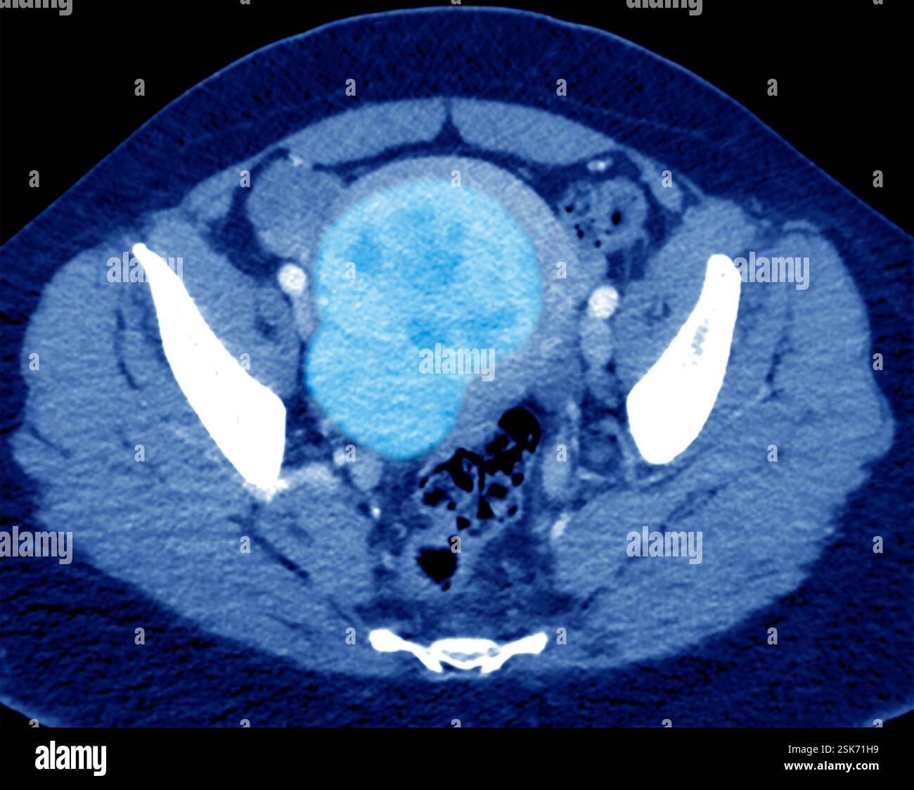 Coloured computed tomography (CT) scan in axial section of the pelvis ...