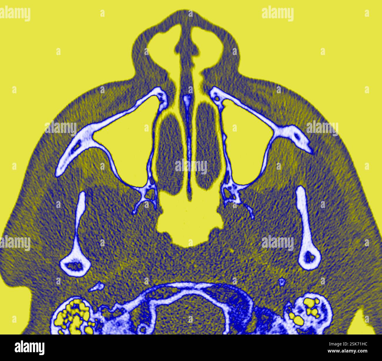 Coloured computed tomography (CT) scan section through the head showing ...