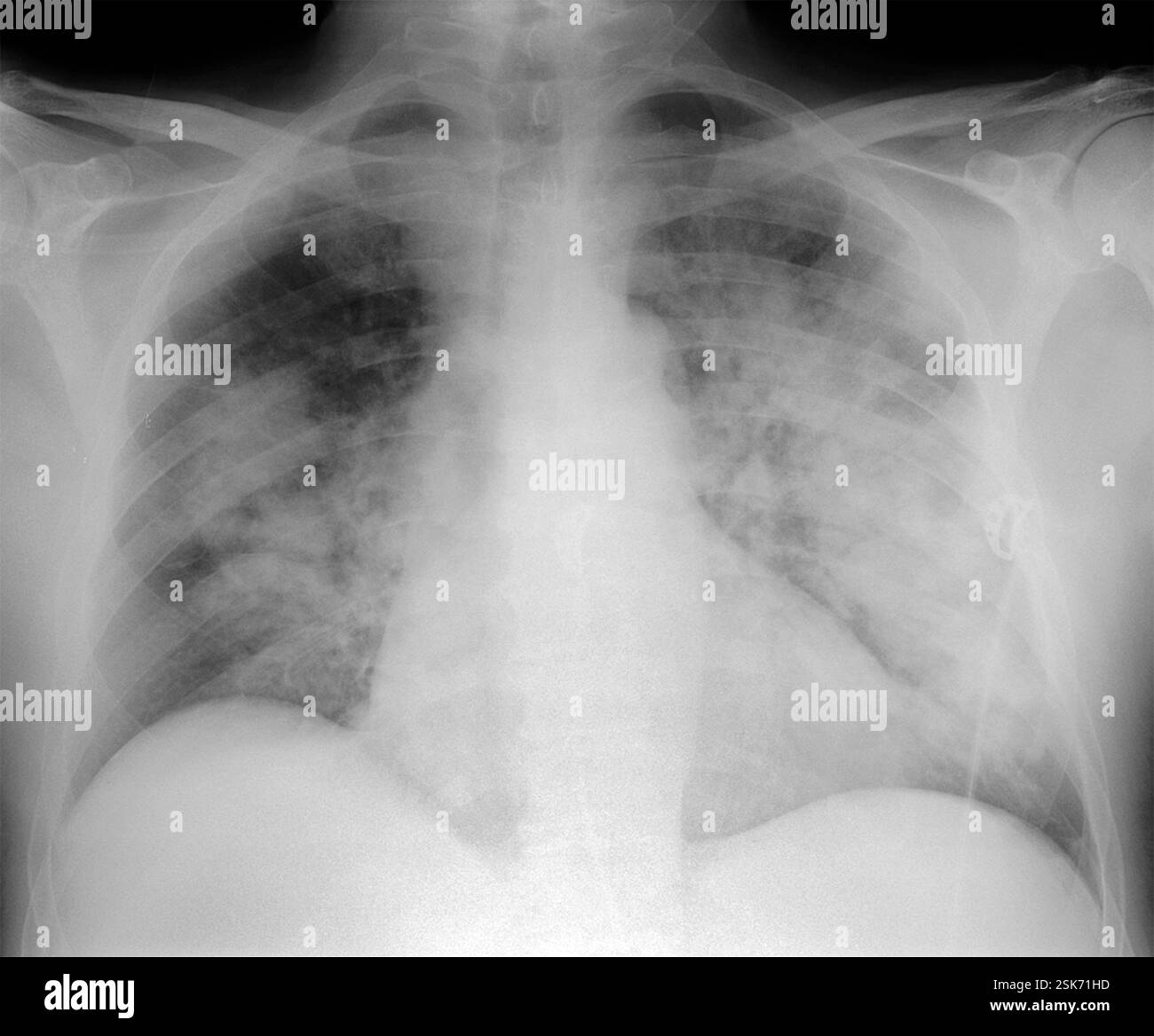 X-ray of the chest of a 68 year old man with left ventricular failure ...