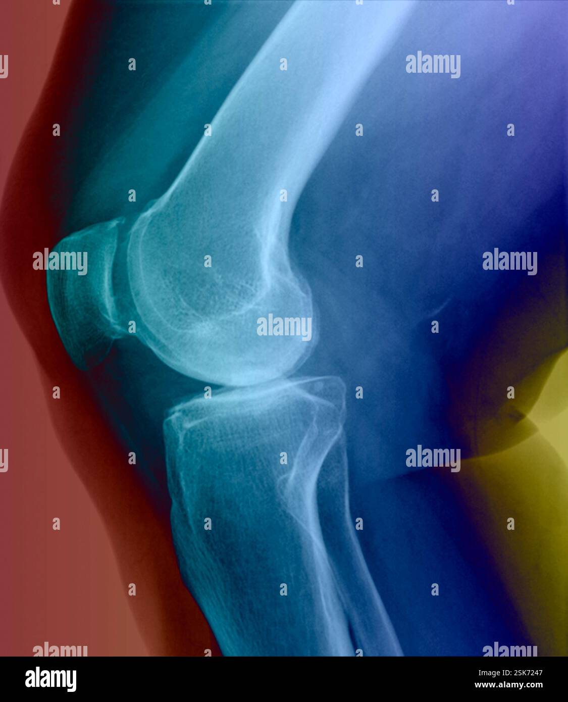 Coloured X-ray of a side view of the right knee of a 70 year old female ...