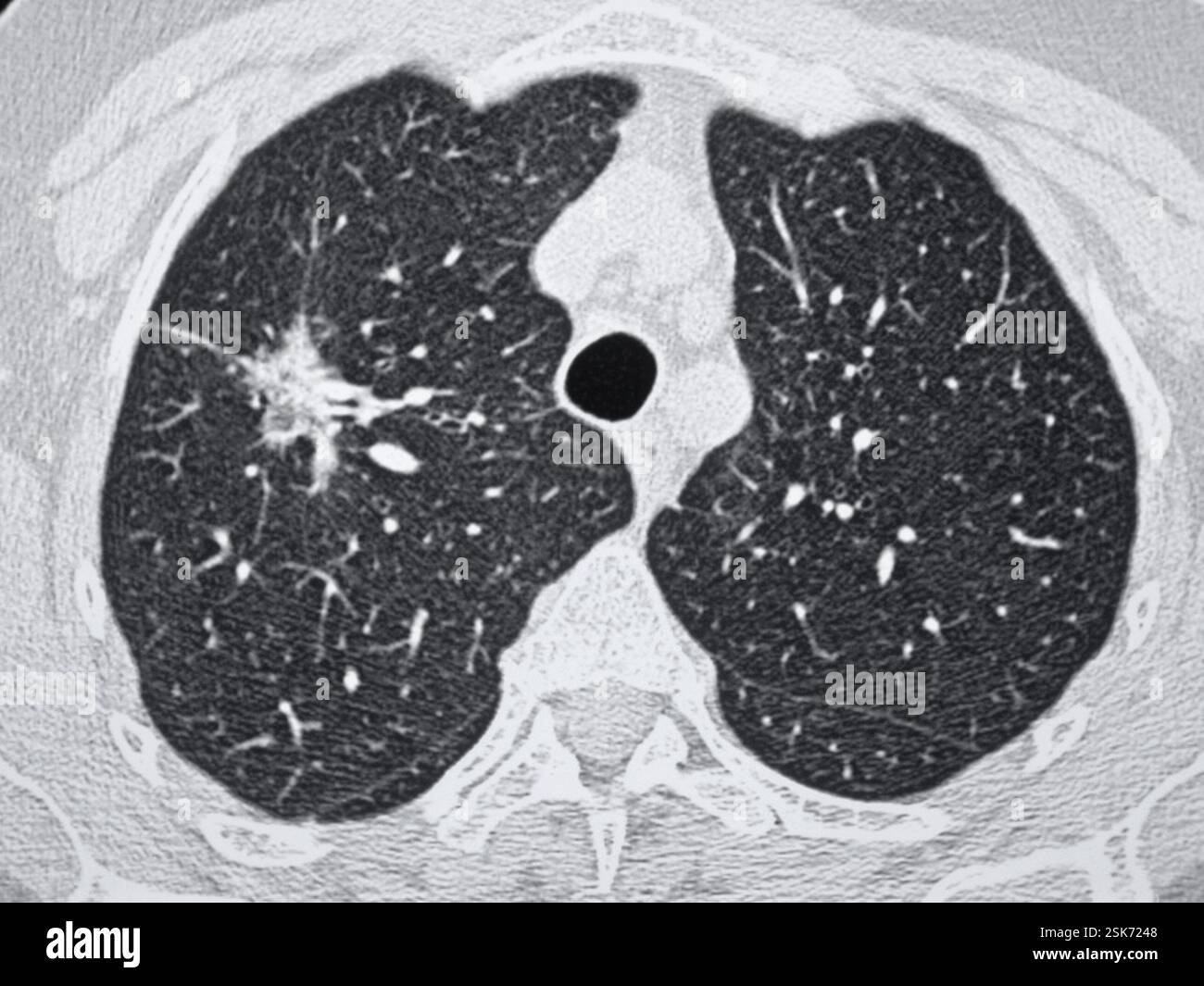 Pelvic bone metastases from breast cancer, CT and PET scans Stock Photo ...