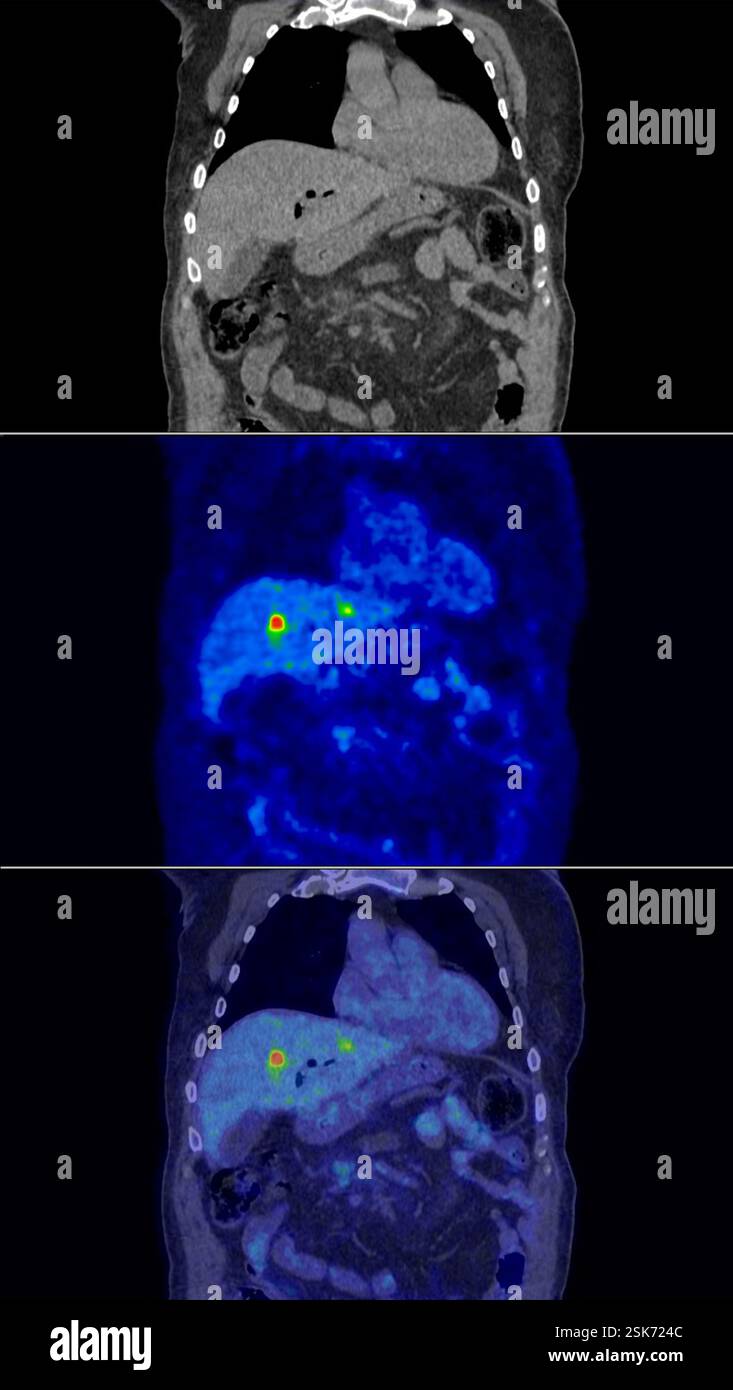Computed tomography (CT, top) and coloured positron emission tomography (PET, centre) scans in ...