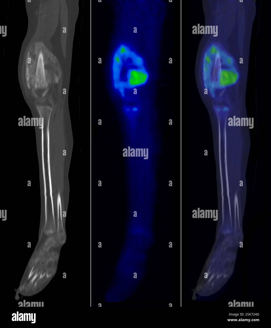 Bone cancer of the leg, computed tomography (CT) and positron emission ...