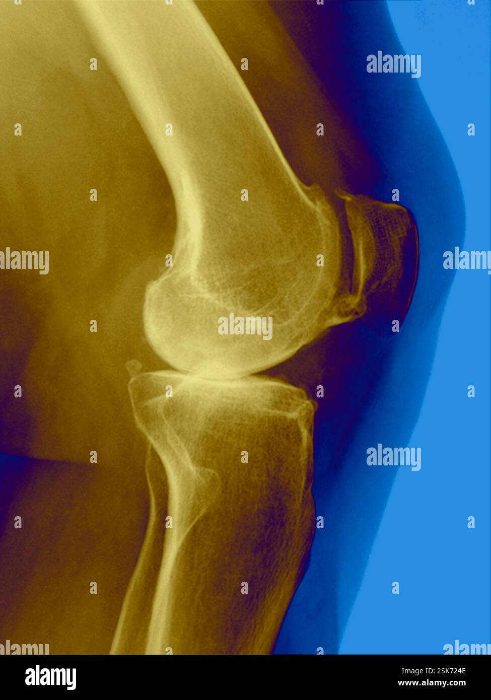 Coloured X-ray of a side view of the left knee of a 70 year old male ...