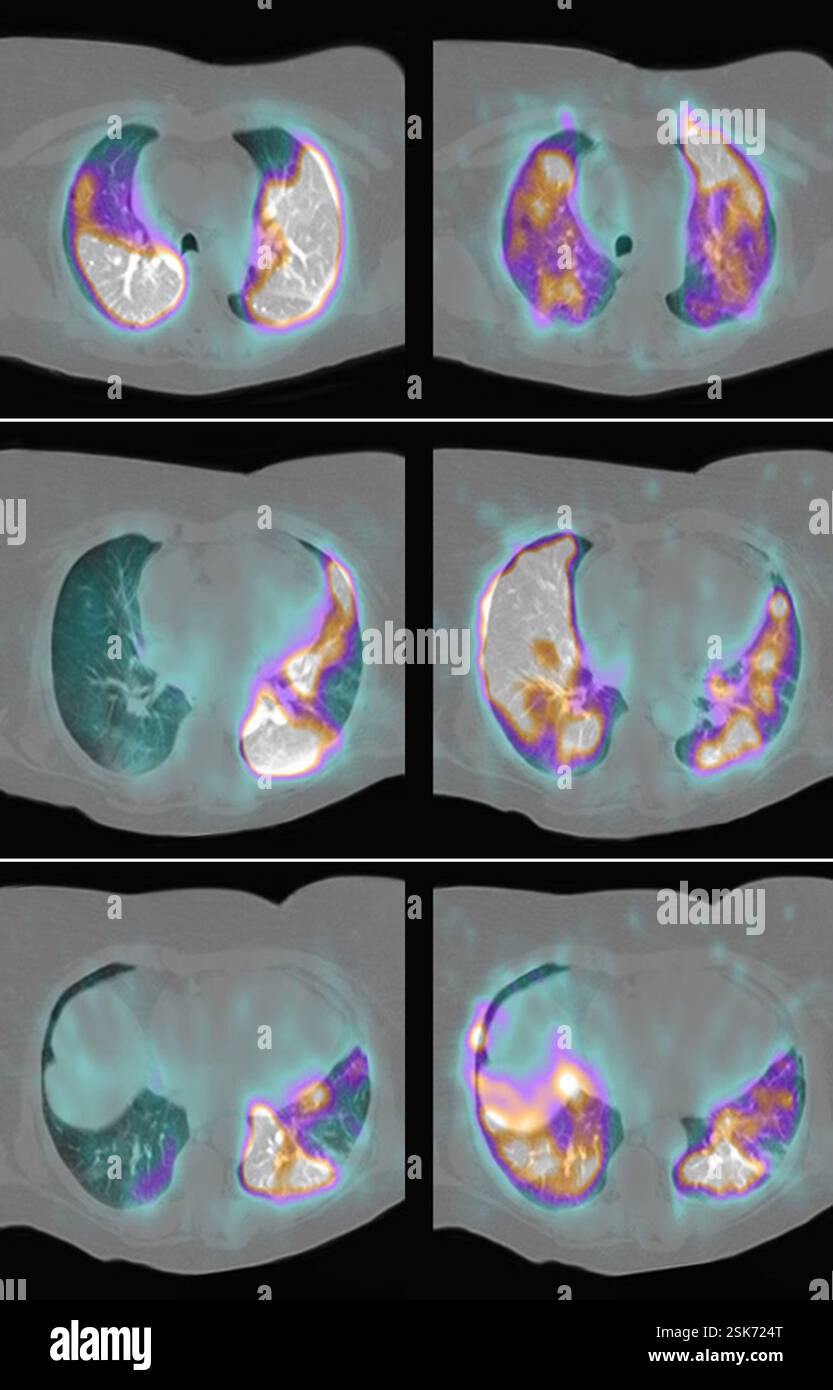Pelvic bone metastases from breast cancer, CT and PET scans Stock Photo ...