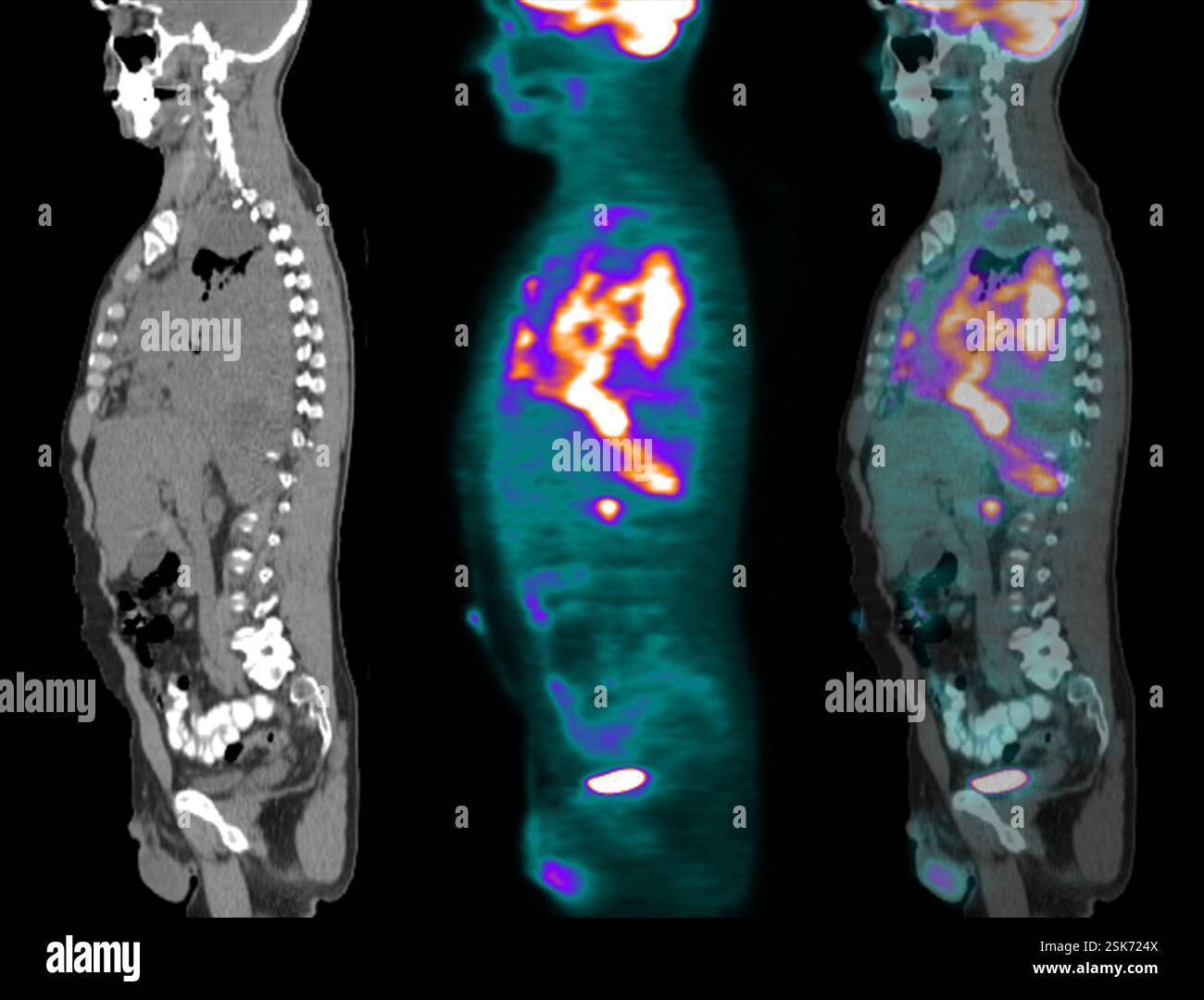 Non-Hodgkin lymphoma, CT and PET scans Stock Photo - Alamy
