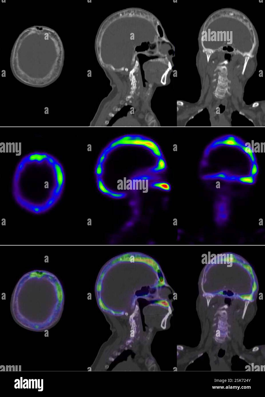 Non-Hodgkin lymphoma, CT and PET scans Stock Photo - Alamy