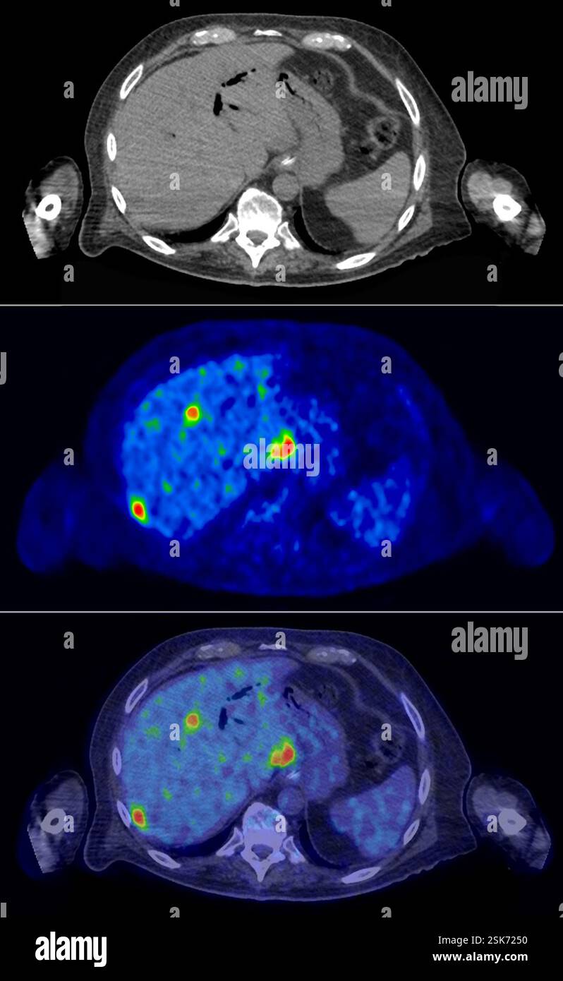 Computed tomography (CT, top) and coloured positron emission tomography (PET, centre) scans in ...